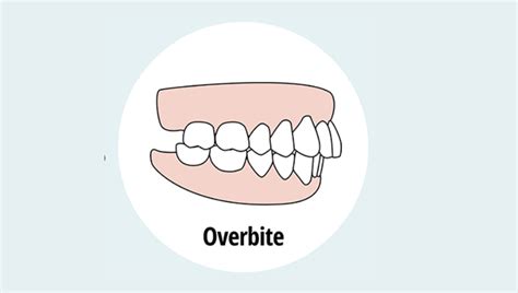 How Does Invisalign Work For Overbite Correction White Center Smiles