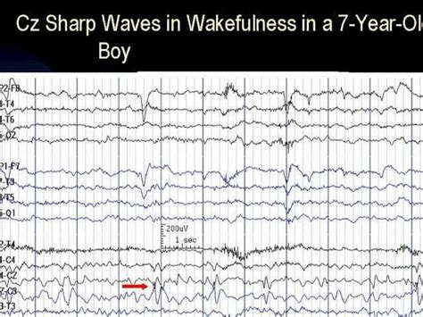 BASICS OF ELECTRO ENCEPHALOGRAM EEG BASICS PPTX Brain And Nervous System Disorders