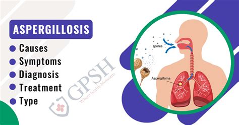 Aspergillosis Types Causes Symptoms Diagnosis And Treatment
