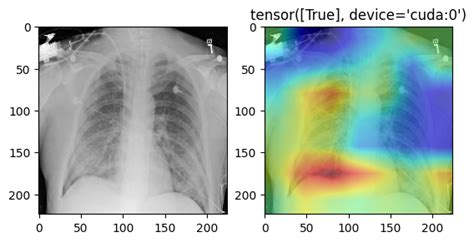 Github Parham2013pneumonia Classification Pytorch
