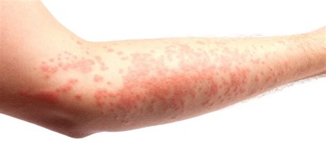 Erythematous Papular Rash