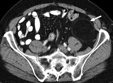 Liposarcoma Radiology Imaging Of Liposarcoma Classification Patterns