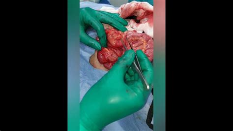 Subserous Retrocecal Appendix Youtube