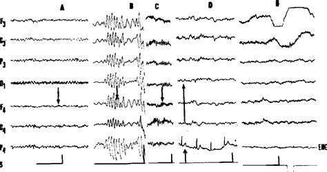 Figure 2 From Spectral Analysis Of The Eeg In Meditation Semantic Scholar