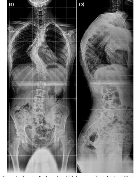 Figure 1 From Dystrophic Scoliosis In Neurofibromatosis And Rib Head Resection A Case Report
