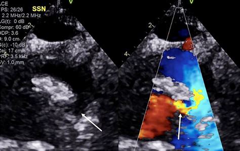 Patent Ductus Arteriosus Pda Dual Display Gray Scale Left And Download Scientific Diagram