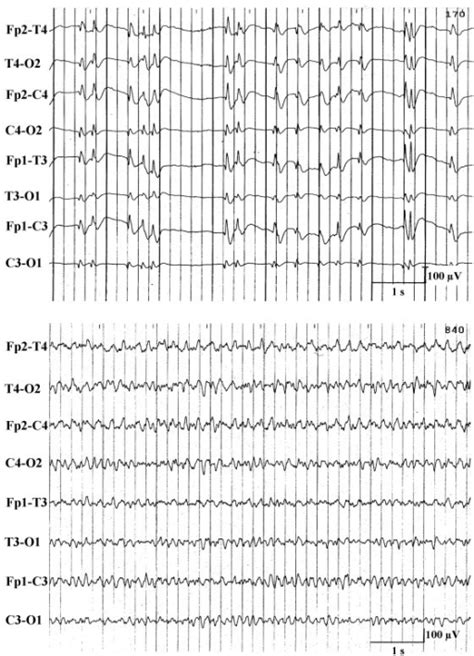 Transitional Eeg Pattern Between Burst Supp Open I