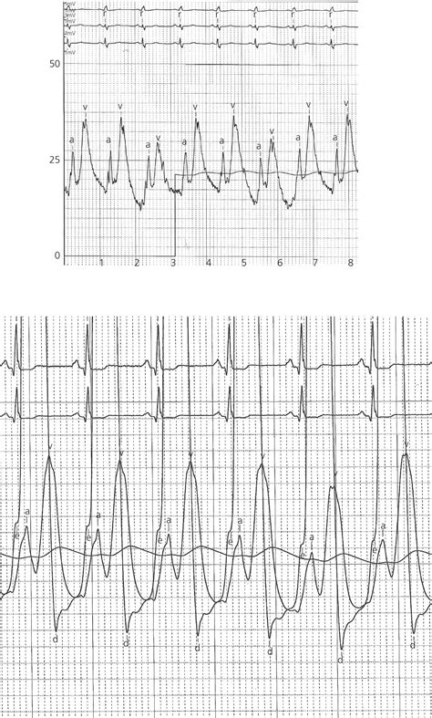 Abnormal Cvp Waveform