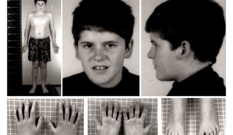 Prader Willi Syndrome Md Searchlight