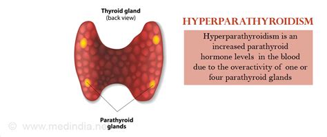 Hyperparathyroidism Causes Symptoms Diagnosis Treatment Prevention
