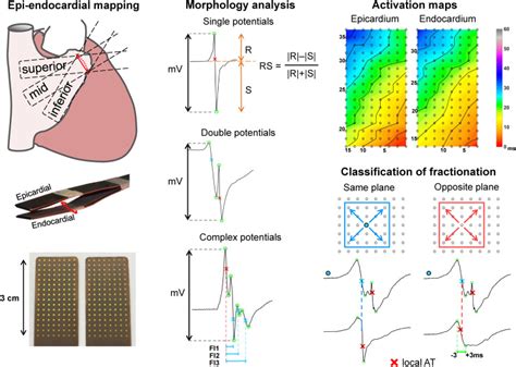 Unipolar Atrial Electrogram Morphology From An Epicardial And