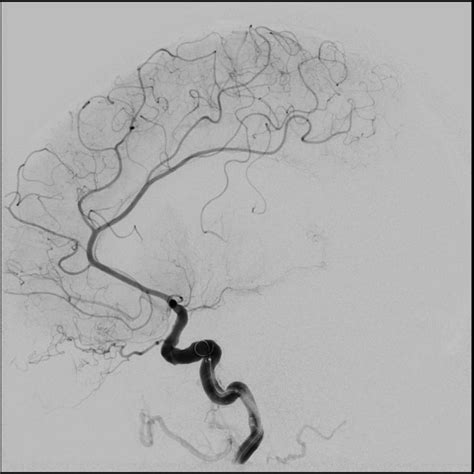 File Proximal Right Mca M1 Segment Embolic Occlusion Radiopaedia 56974