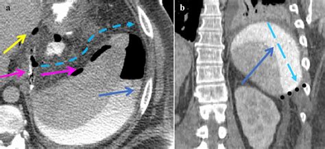 Case Illustrating The Left Subphrenic Space In A 36 Year Old Patient