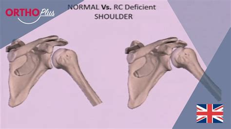 Presentazione “can Reverse Shoulder Arthroplasty Solve Any Problem