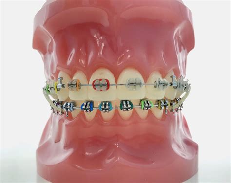 Class Iii Elastics About Braces