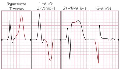 Hyperacute T Waves