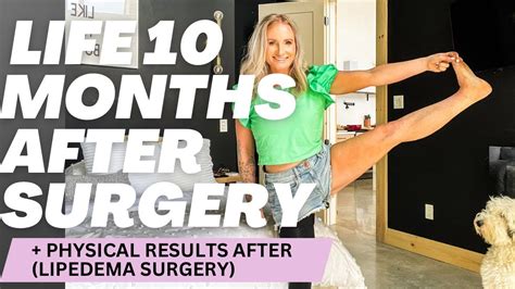 10 Months Post Lipedema Surgery Physical Results Youtube
