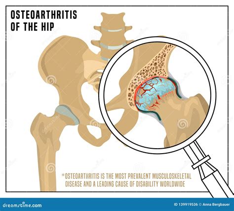 Hip Osteoarthritis Infographic Cartoon Vector