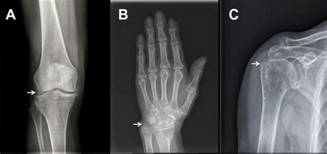Radiographic Cc Notes A Plain Film X Ray Demonstrating Cc Involving