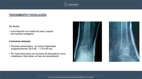 Fractura De Estrés En Metáfisis Tibia Distal Aware Doctor
