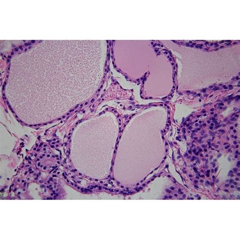 Nodular Goiter Sec Medical And Science Media