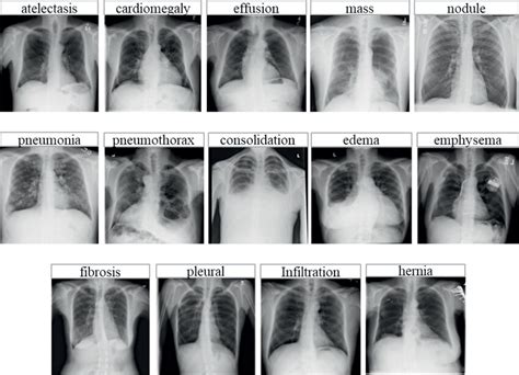 Sample Of Labeled Chest Xray14 Dataset Download Scientific Diagram