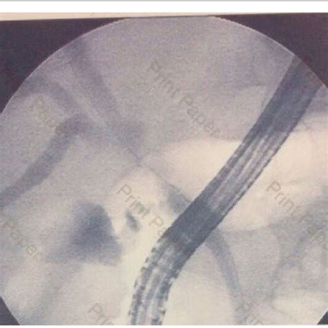 Ercp Show Stricture Of Common Hepatic Duct Just Below Hepatic Confluence Download Scientific