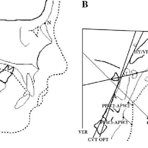 Bony And Soft Tissue Reference Points A Planes And Measured Download Scientific Diagram