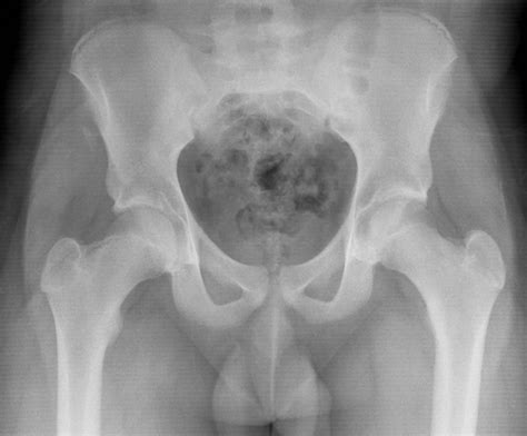 Avulsion Fractures Of The Pelvis In Adolescents Eurorad