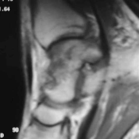 The Anteroposterior View Demonstrates Tibiotalar Joint Dislocation Download Scientific Diagram