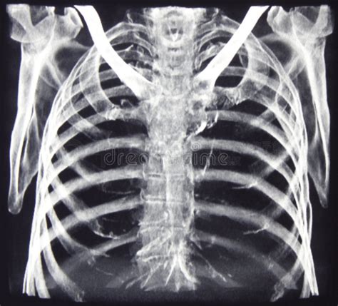 病高清图片 胸骨ct 胸骨ct图片免费下载 5113129619 千图网pro