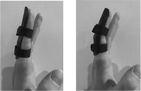 Dorsal Blocking Orthoses For Proximal Interphalangeal Joint Volar Plate