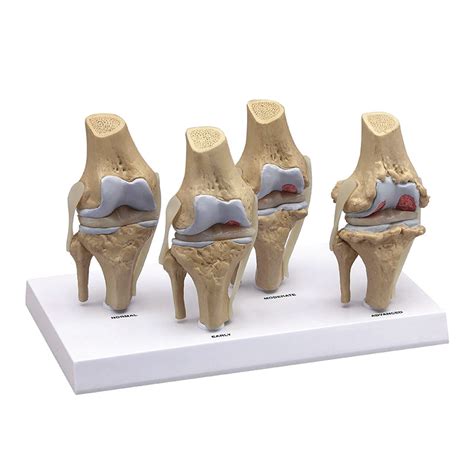 Knee Joint With Pathologies Model 4 Stages Nasco Healthcare