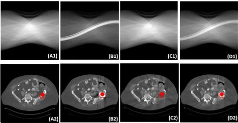 Metal Artifact Reduction Models Code And Papers Catalyzex