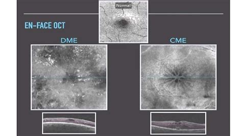 Oct And Octa In Dr Practical Discussions Pptx