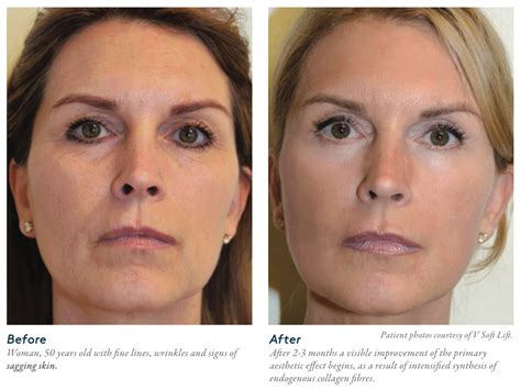 Pdo Threads Your Questions Answered The Lett Center