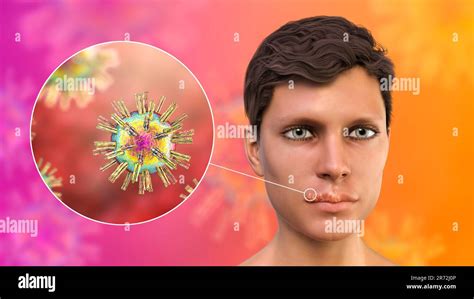 Cold Sore On The Lip Of A Man And Closeup View Of Herpes Simplex