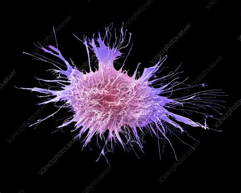 Cervical Cancer Cell Sem Stock Image C060 1669 Science Photo Library