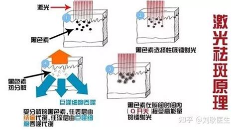 基础知识科普激光祛斑原理 知乎