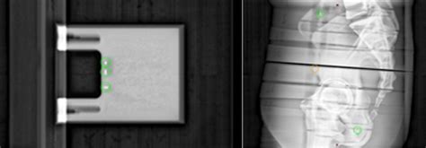 Phantoms Used For Algorithm Validation Included The Calypso Daily Qa