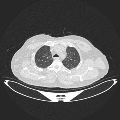Detection Of Lung Cancer Object Detection Dataset V1 Lung Cancer
