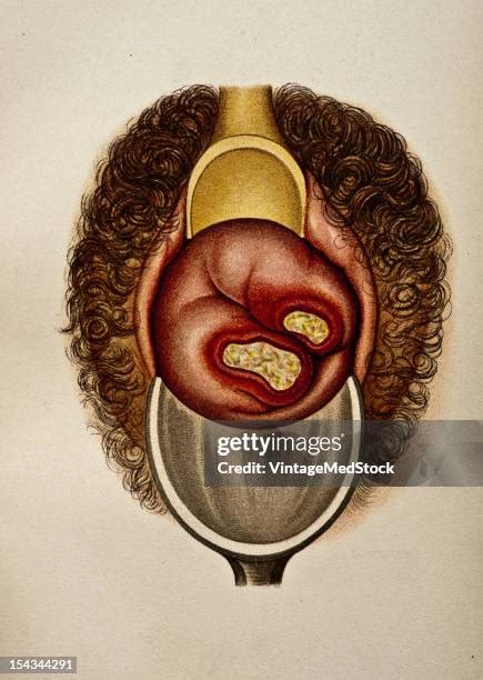 Atlas Of Syphilis And The Venereal Diseases Photos And Premium High Res