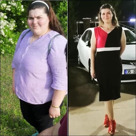 Gastric Sleeve Gastrectomy Or Gastric Bypass Differences Pros And Cons Assoc Prof Dr Ali