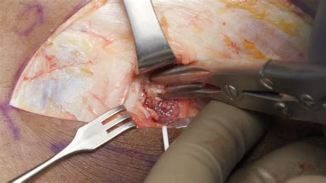 Fibular Head Resection For Biceps Femoris Snapping Syndrome Nyu Langone Orthopedic Digital Library