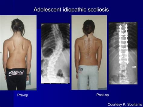 Late Post Operative Spinal Infections Ppt