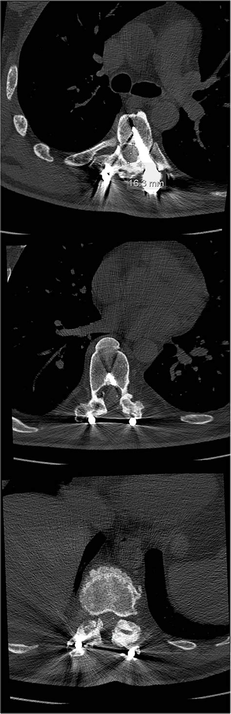 Final Follow Up Ct Scan Axial Views Showing Adequate Width Of The Download Scientific