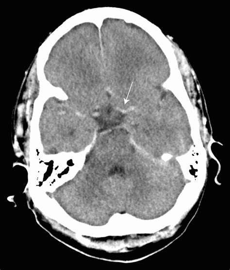 Pseudosubarachnoid Hemorrhage After Cardiopulmonary Arrest