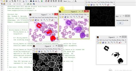 Blood Cancer Leukemia Cancer Detection Using Image Processing Matlab