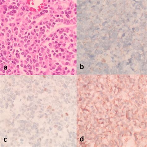 Histopathologic Results A A Hypercellular Mass With Carrot Shaped Download Scientific