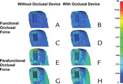 Maximum Principal Stress Mpa Distribution In Peri Implant Bone At